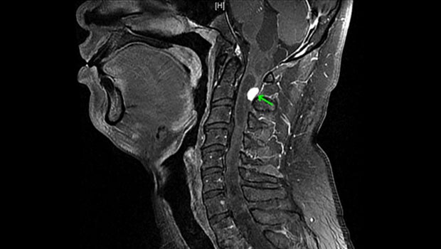 Surprising cause of man's persistent hiccups - CBS News