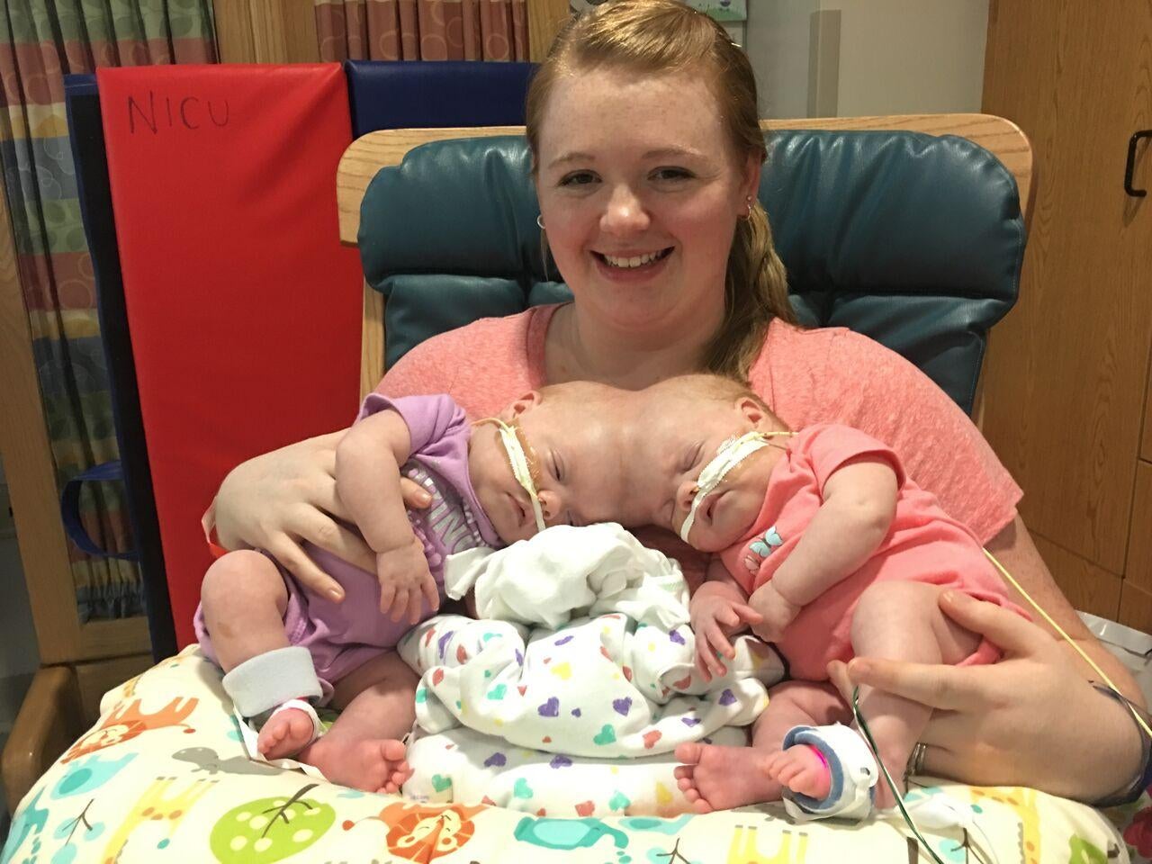 Surgeons Separate Twin Girls Joined At The Head CBS News