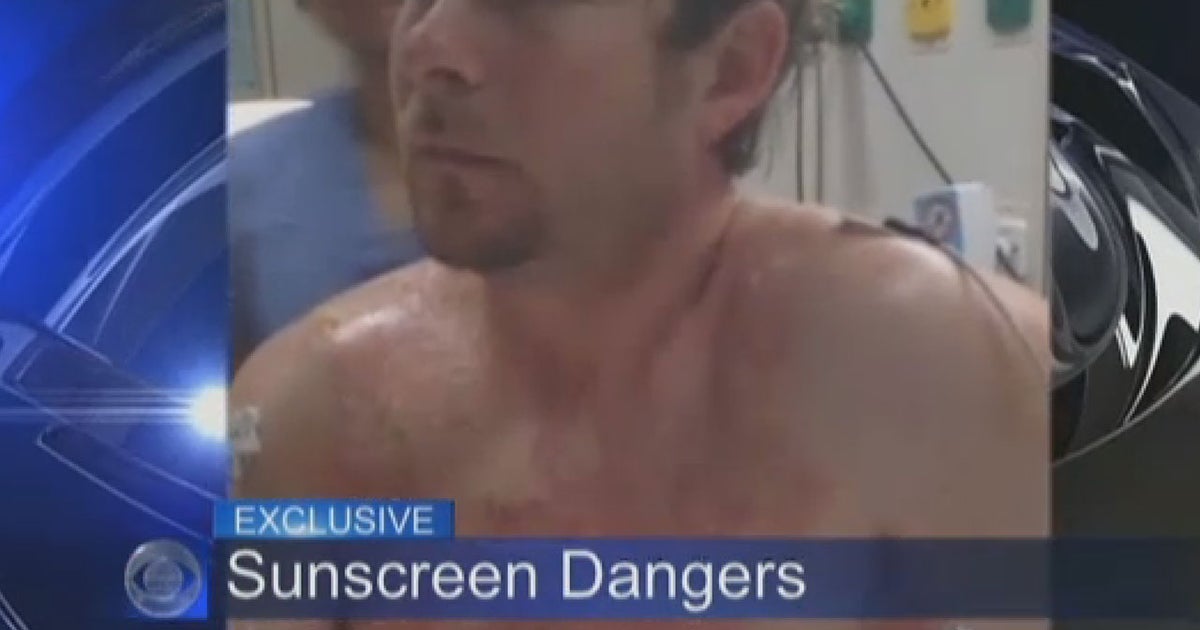 Man catches fire after applying spray-on sunscreen before grilling ...