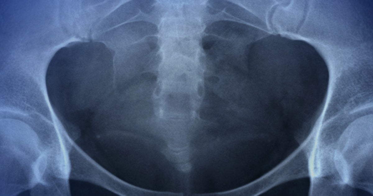 Morning Rounds: What's best for your bones? - CBS News