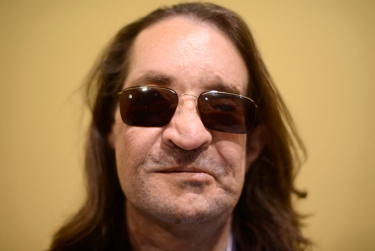 Amazing face transplants (GRAPHIC IMAGES)