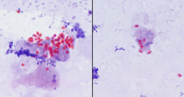 Rare parasite from organ donor sickens 3 people - CBS News