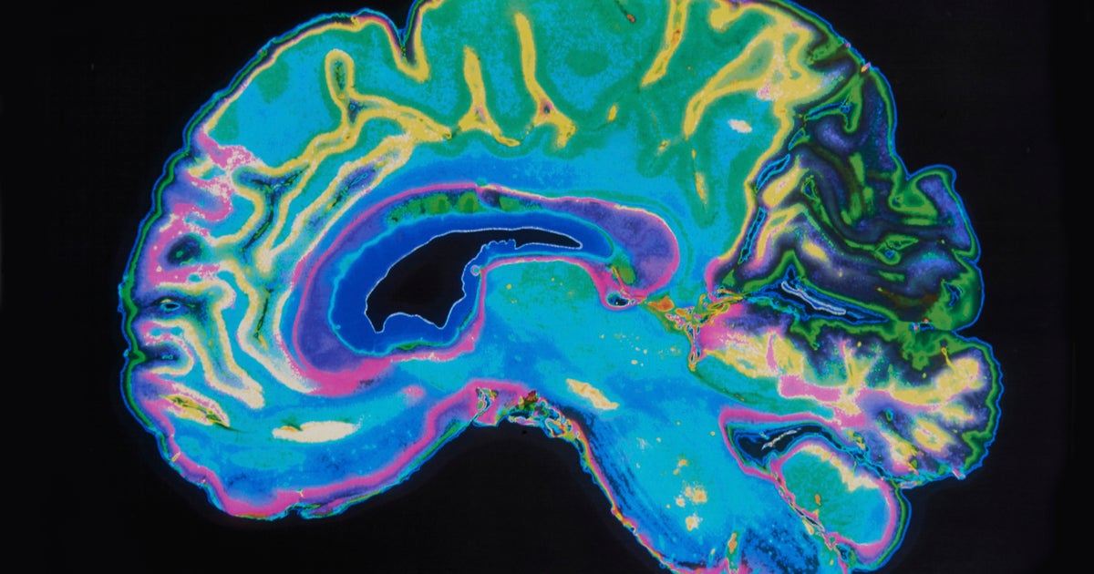 MRI Scans Reveal Brain Differences In Kids With ADHD CBS News
