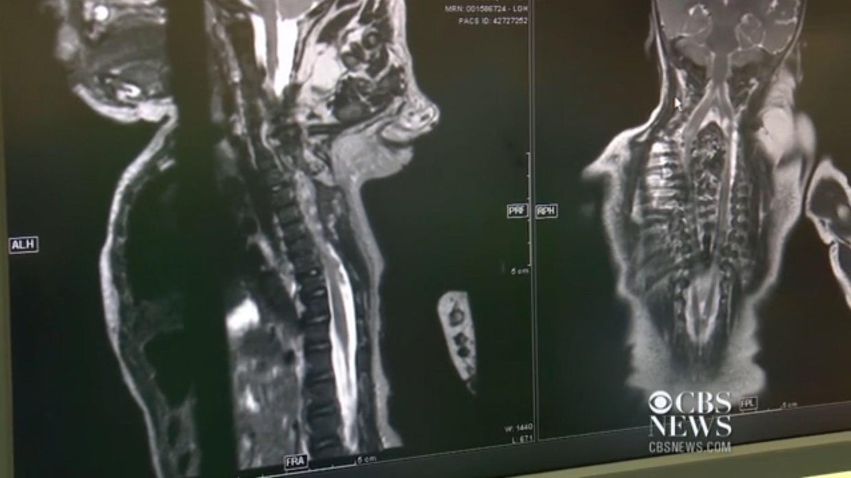 Baby born with extra legs undergoes successful surgery in Illinois ...